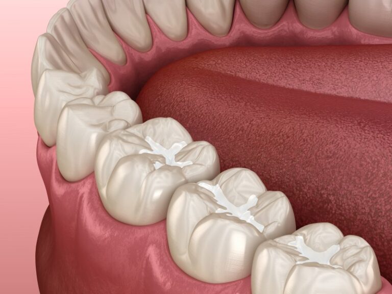 Dental Crowns | Dental Fillings | Esplanade Dental